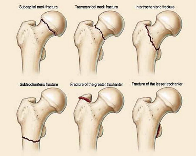 Fratture del collo del femore - Terzaeta.com